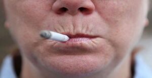 Home | Treatment for Smokers Lips : Why It's Important